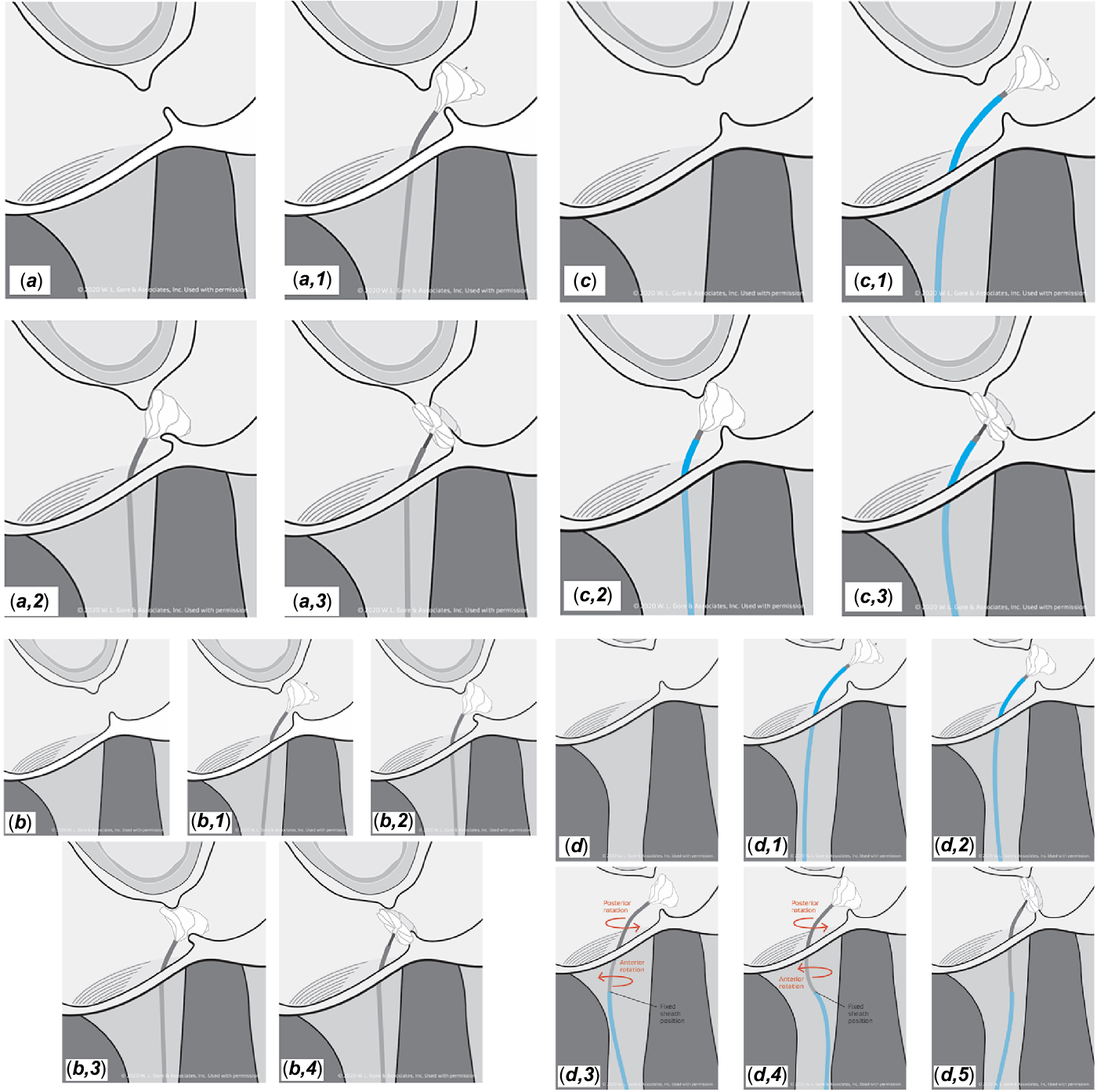 Gore Cardioform atrial septal occluder: deployment procedure and ...