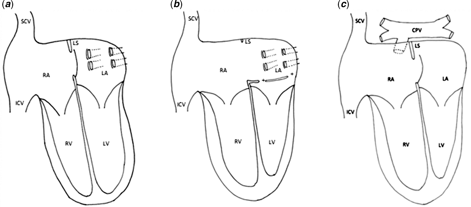 Leftward deviation of the primary septum or dividing left atrial shelf ...