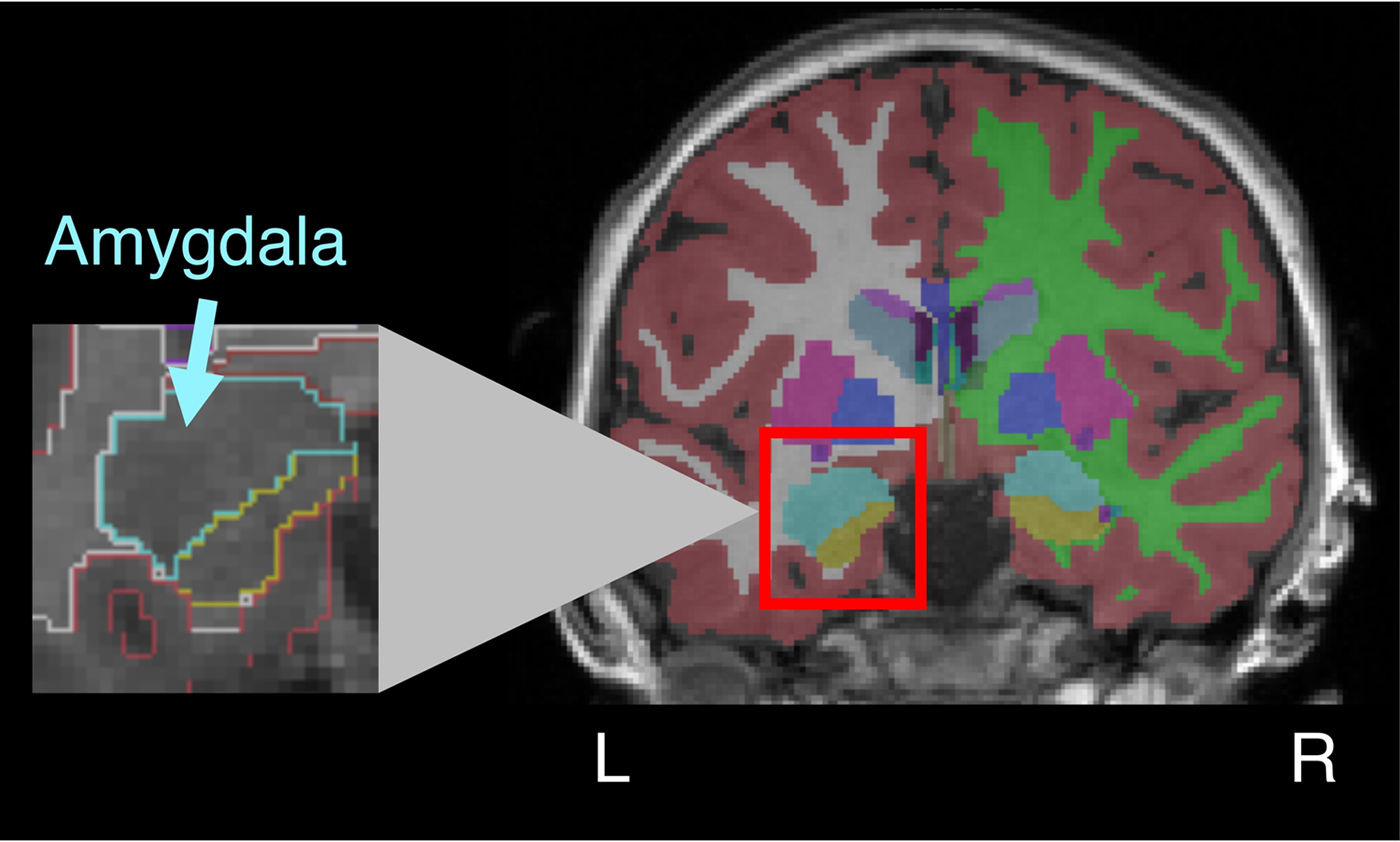 Developmental relations between amygdala volume and anxiety traits ...