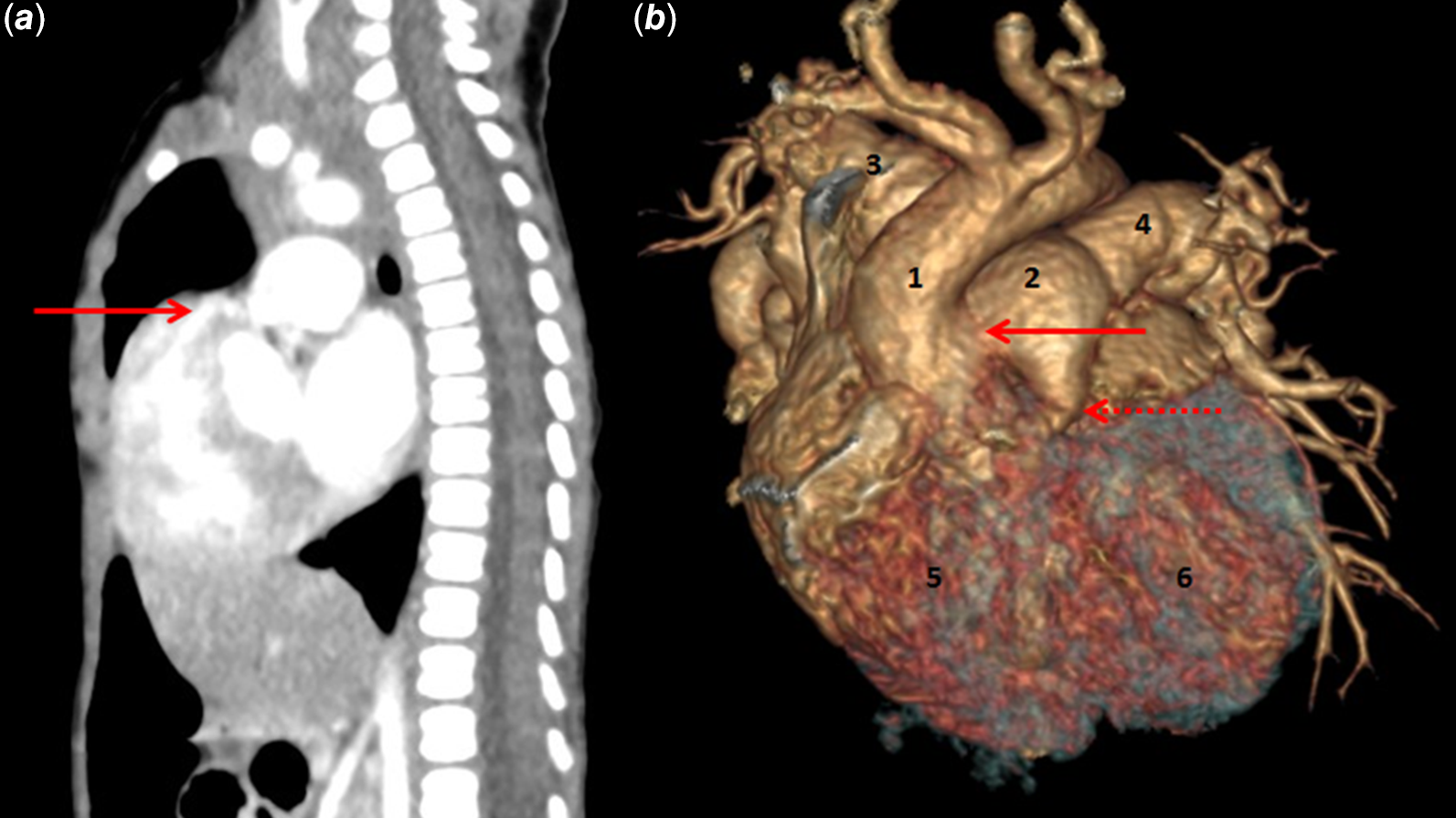 Tetralogy of Fallot with pulmonary atresia and aortopulmonary window ...
