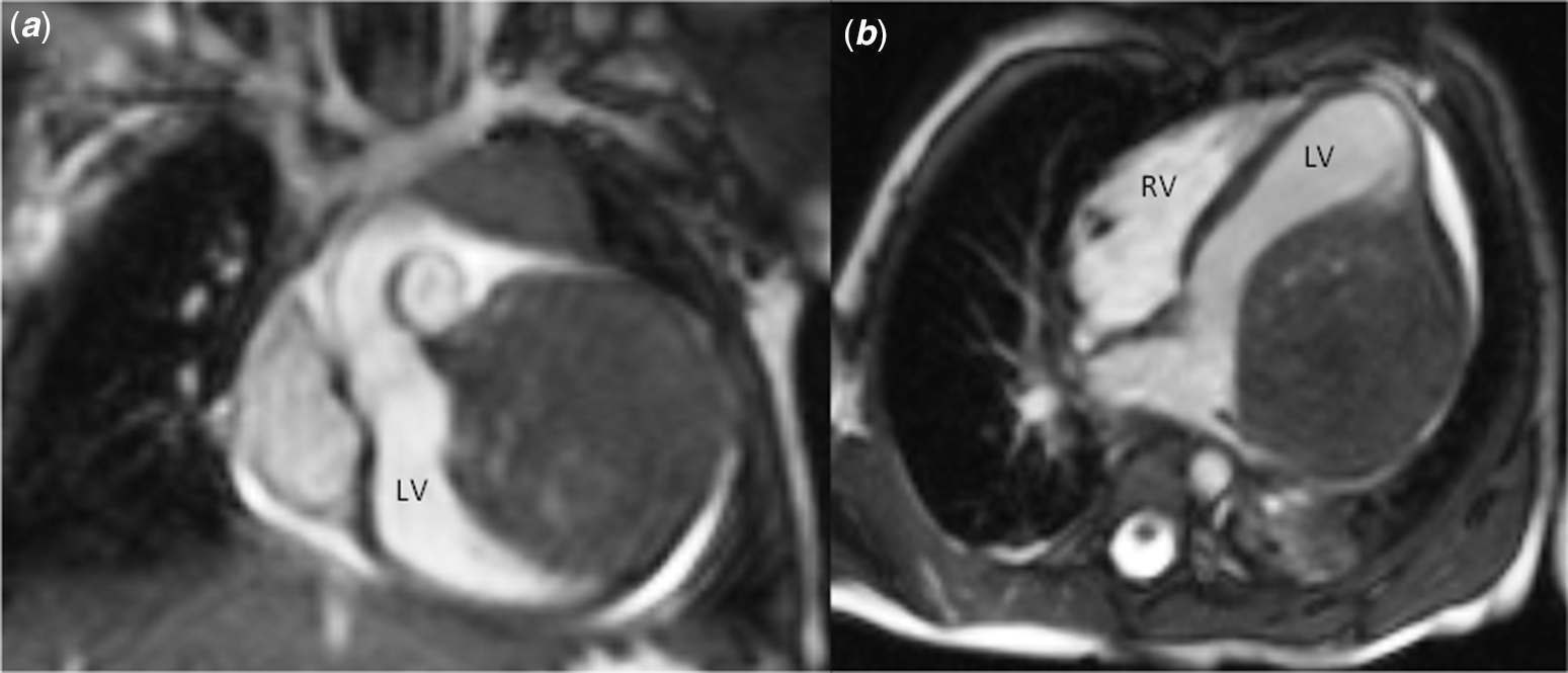 Cardiac tumours in children: a single-centre experience and literature ...