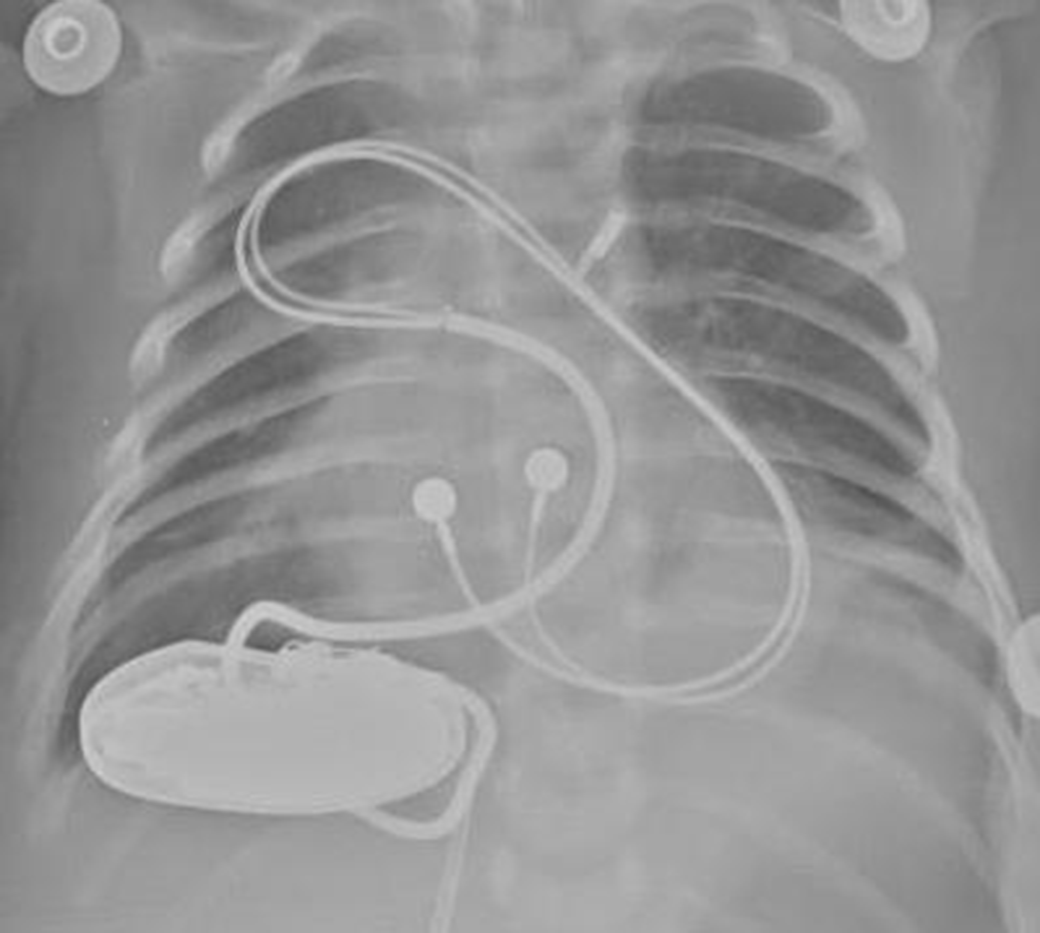 Minimally invasive permanent pacemaker implantation immediately after ...