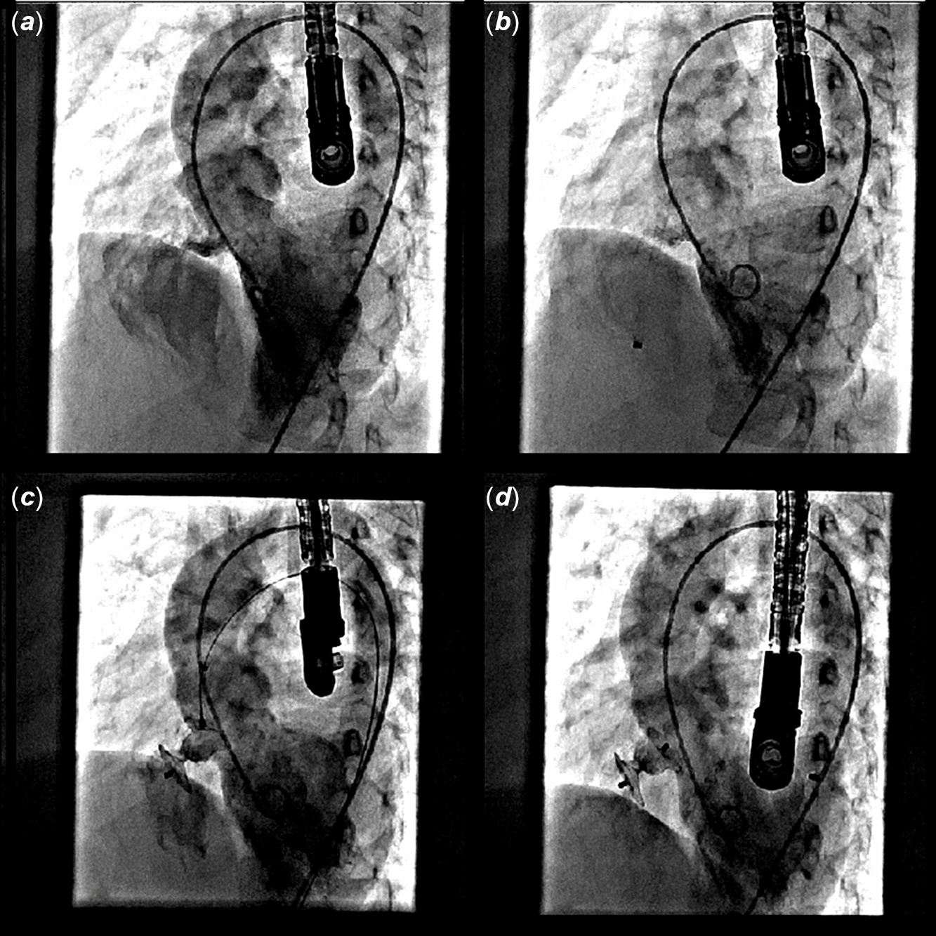 Percutaneous closure of ventricular septal defect using LifeTechTM ...