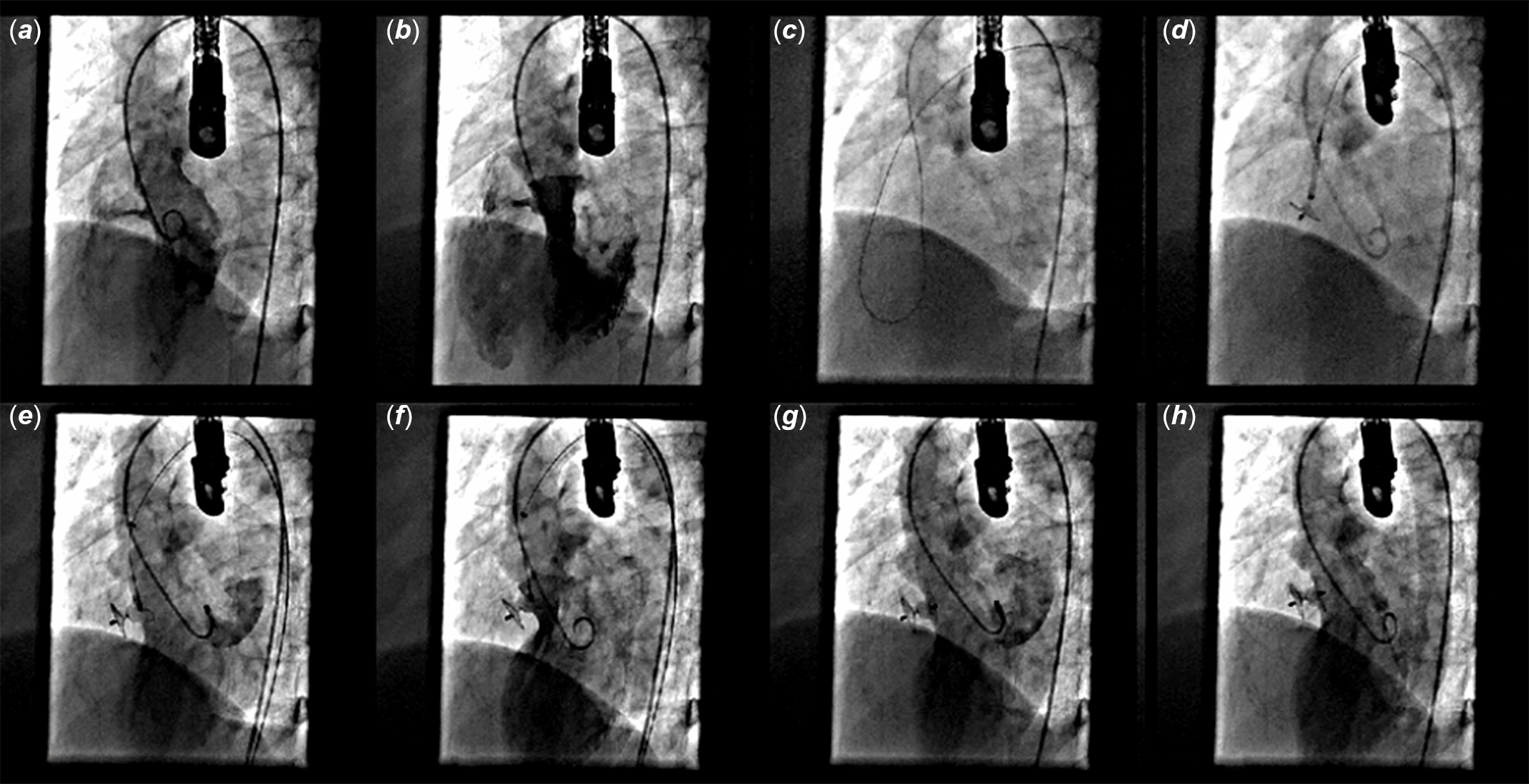 Percutaneous closure of ventricular septal defect using LifeTechTM ...