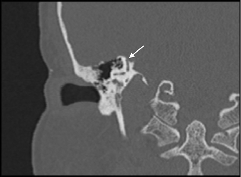 Superior semicircular canal dehiscence repair with small middle fossa ...