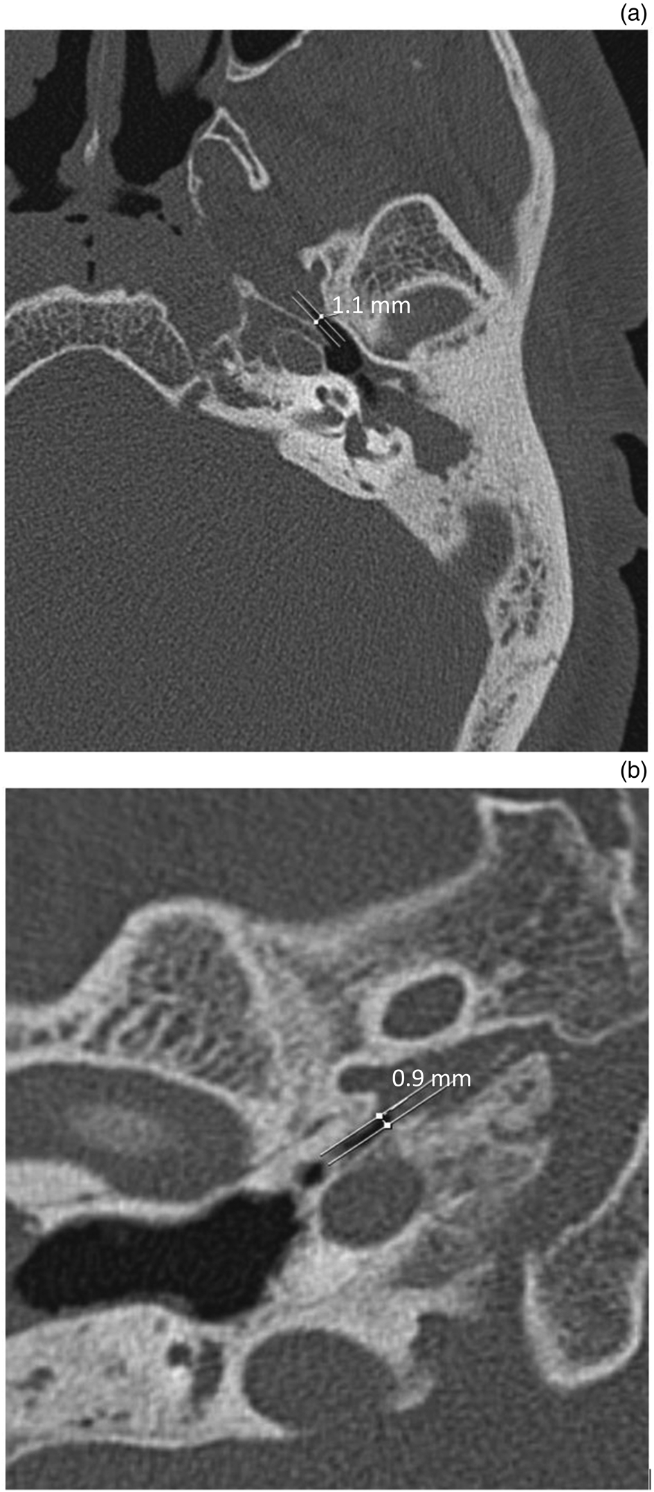 The relationship between dimensions of the Eustachian tube and acquired ...