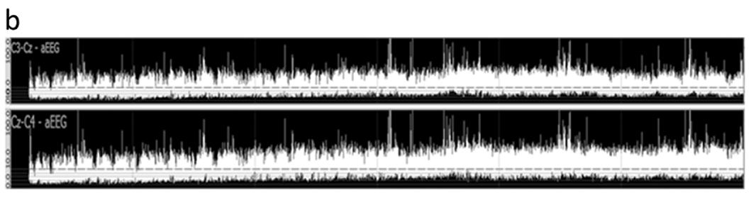 Overview of Continuous EEG Monitoring in Critically Ill Neonates and ...