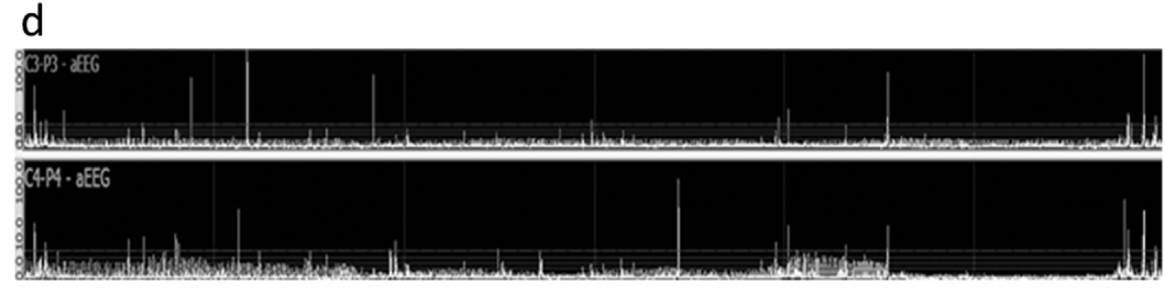 Overview of Continuous EEG Monitoring in Critically Ill Neonates and ...