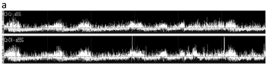 Overview of Continuous EEG Monitoring in Critically Ill Neonates and ...