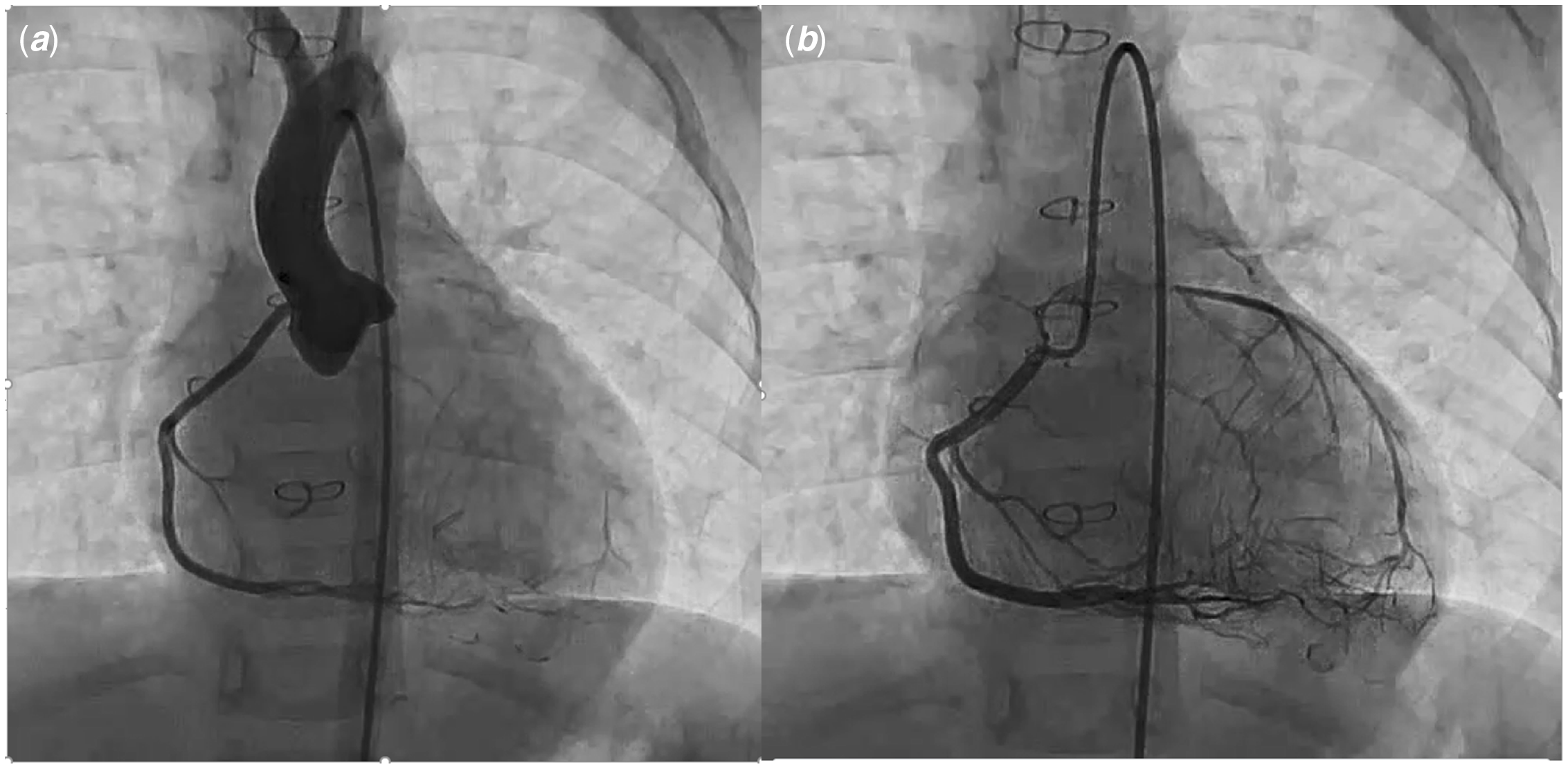 Reconstruction in left main coronary artery atresia with bypass graft ...