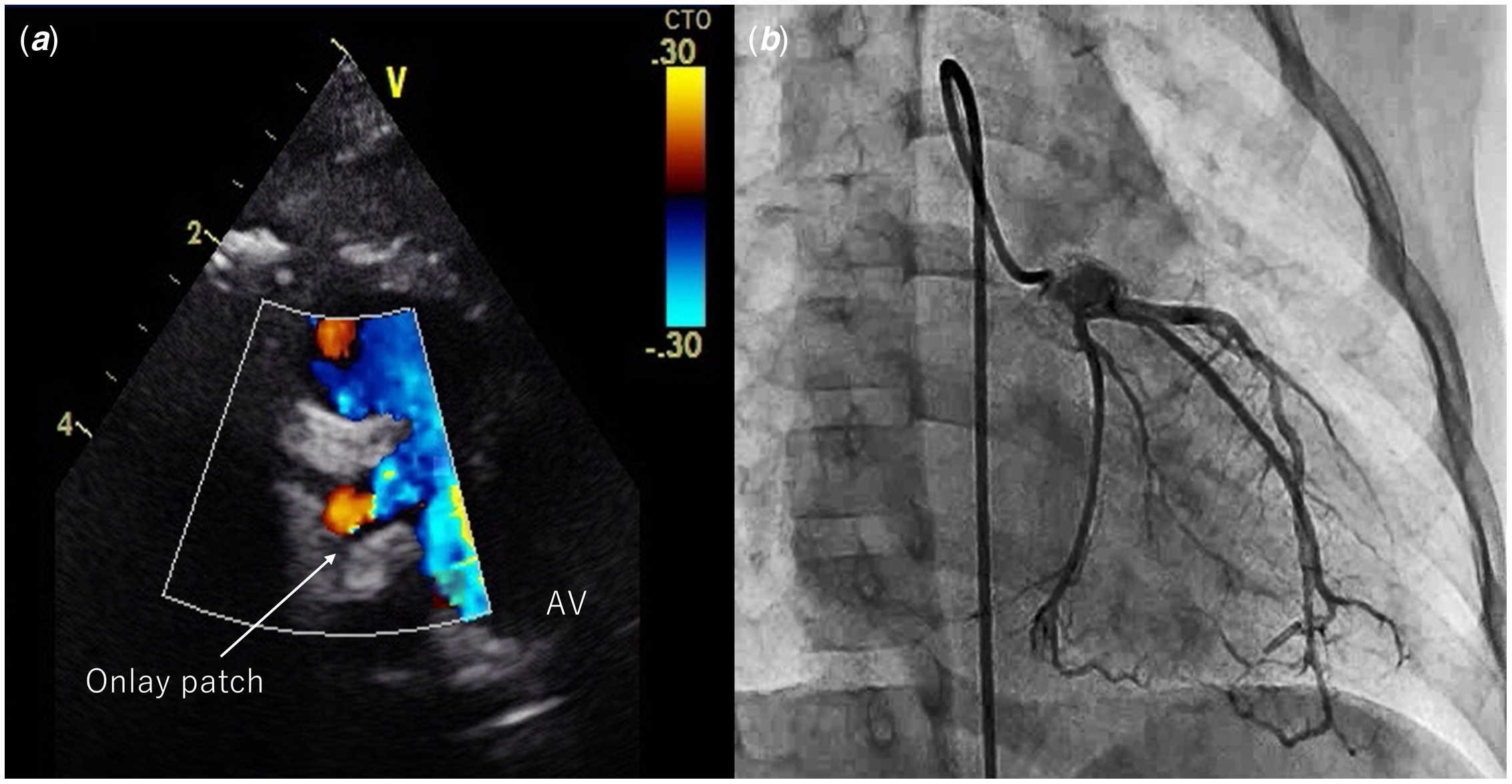 Reconstruction in left main coronary artery atresia with bypass graft ...