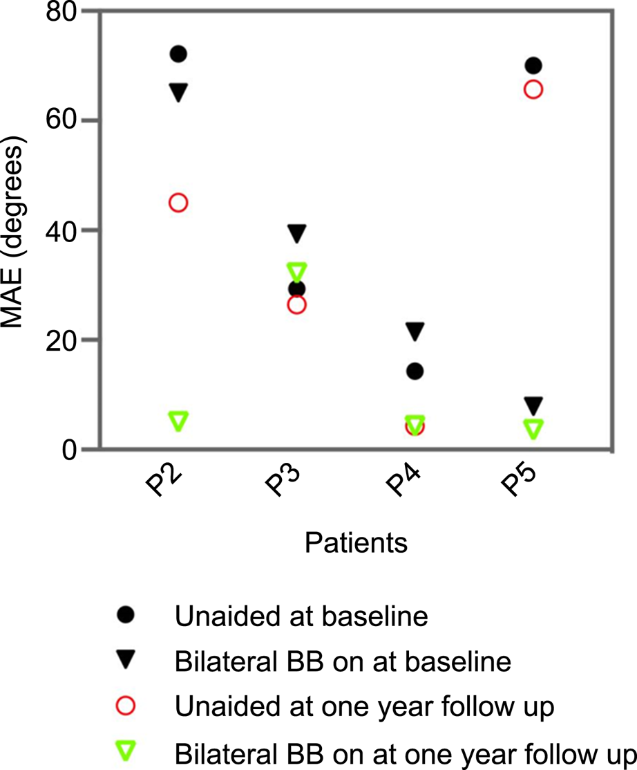 Simultaneous bilateral transcutaneous bone conduction device ...