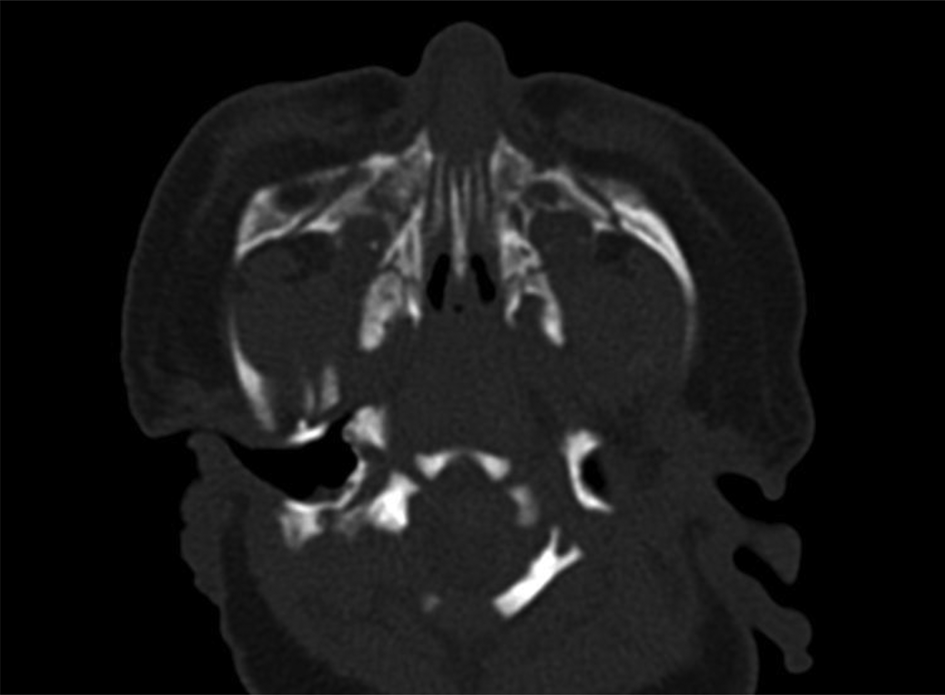 Congenital inferior turbinate hypertrophy: an overlooked entity in ...