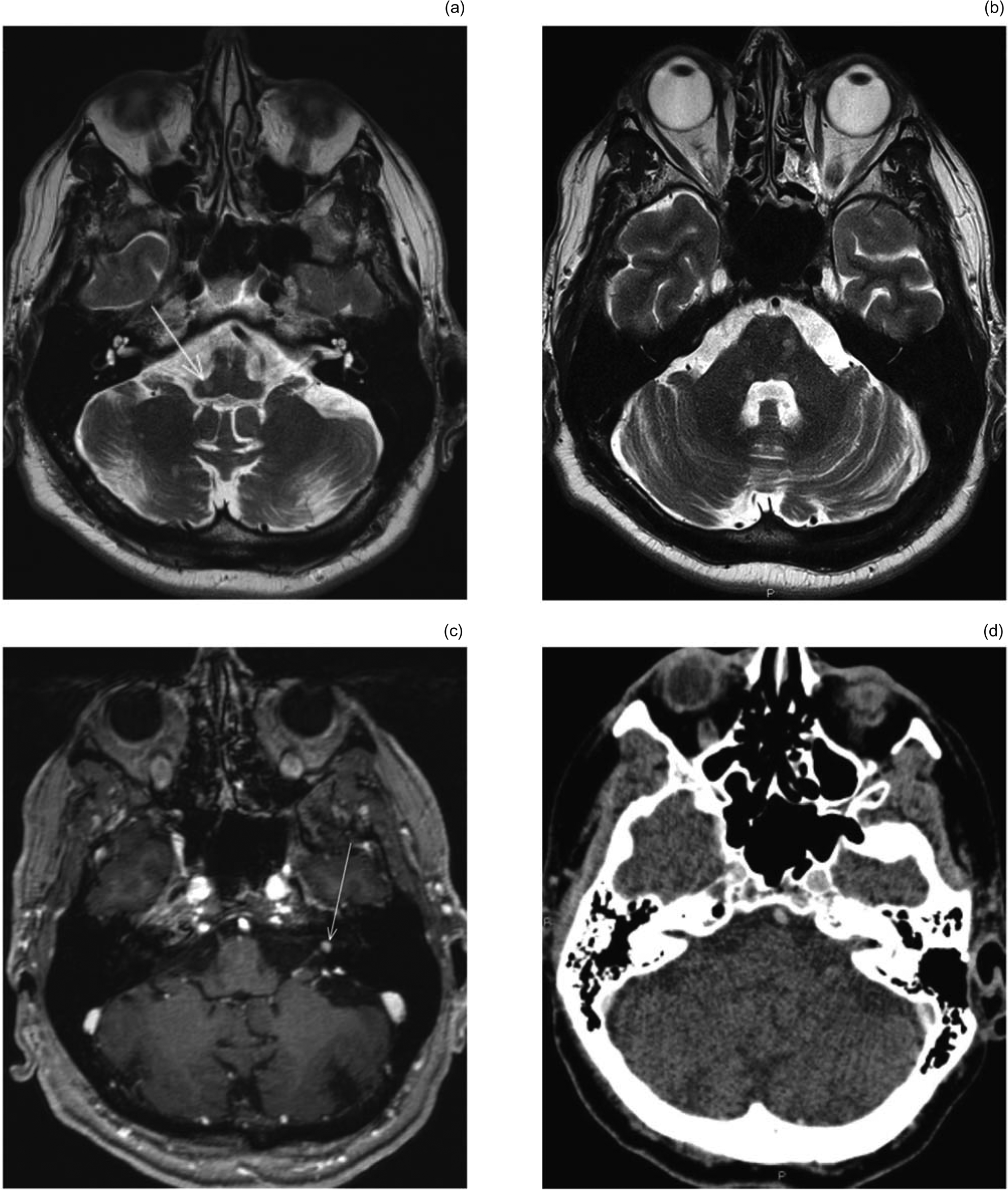 Cochlear implantation of a patient with multiple sclerosis: case report ...