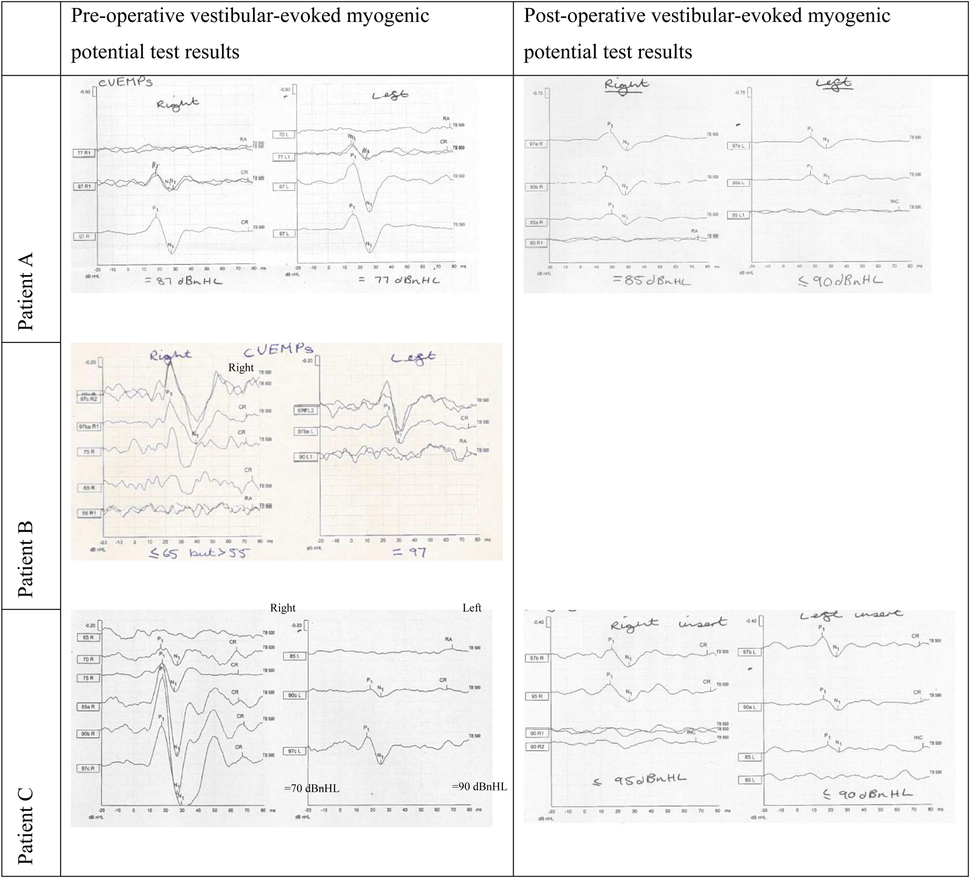 A report on quality-of-life outcomes following transmastoid plugging of ...