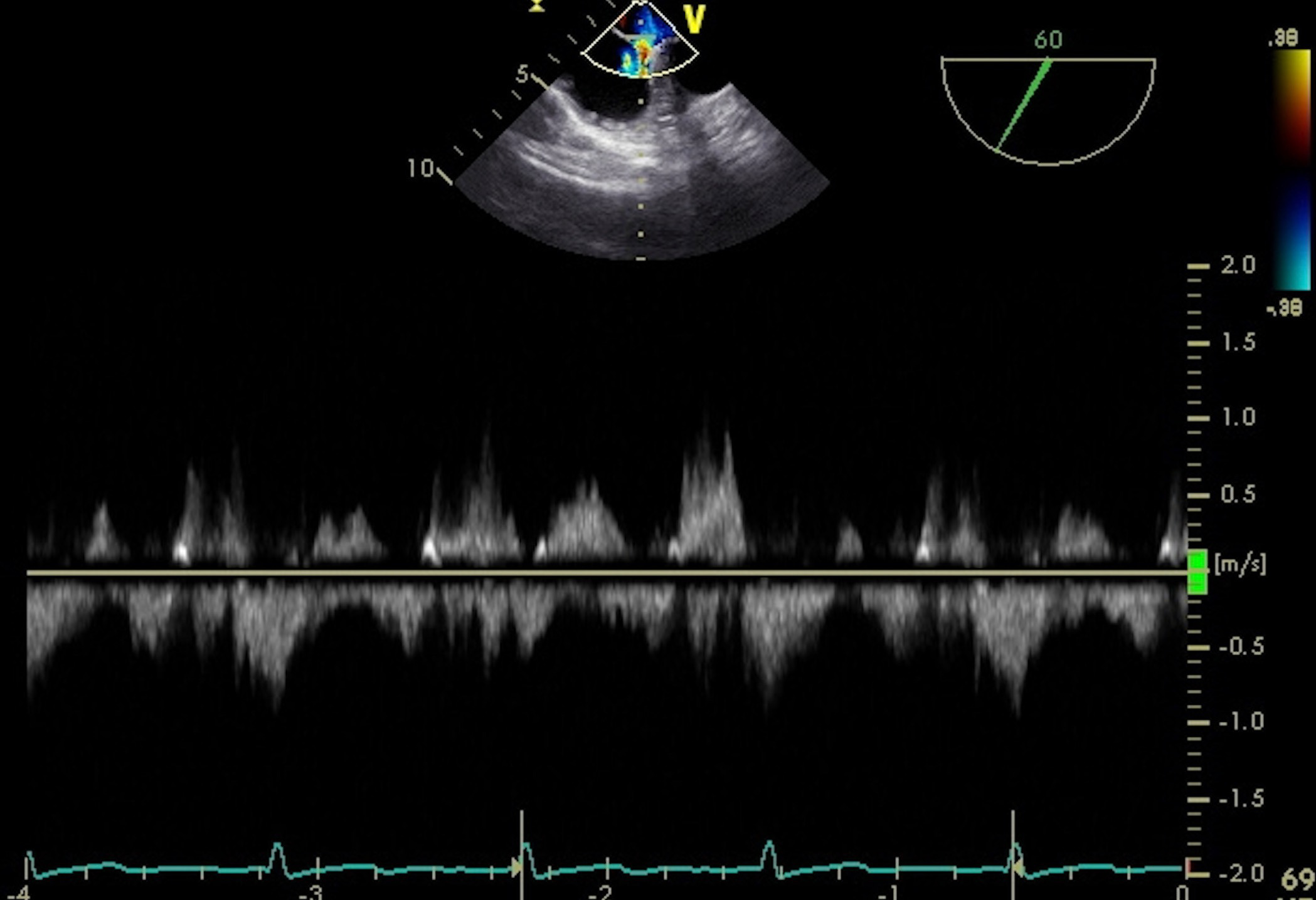 Cyanosis in atrial septal defect with prominent crista terminalis ...