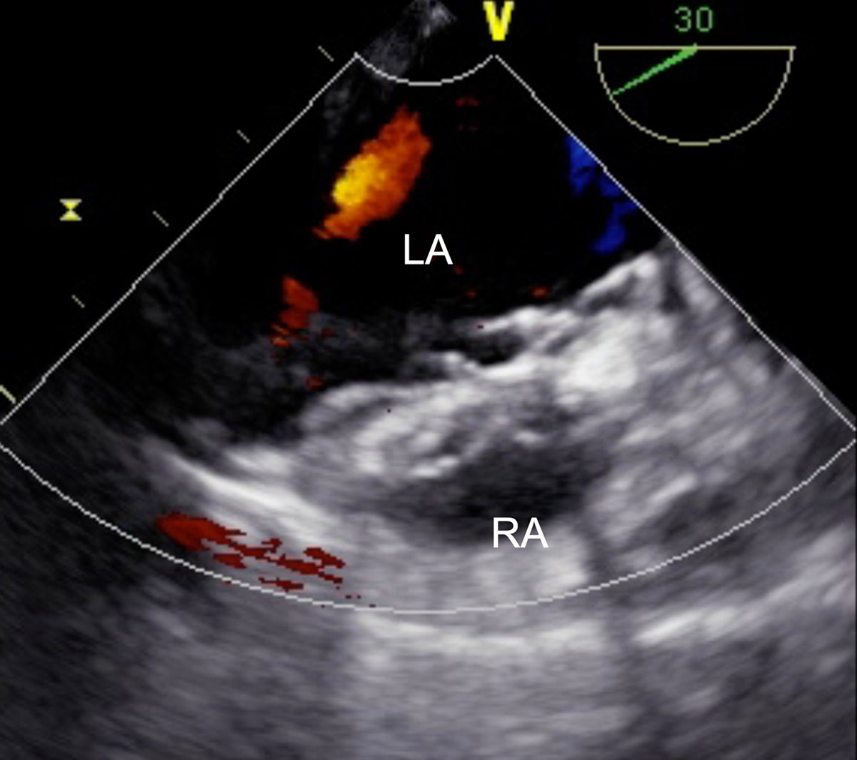 Cyanosis in atrial septal defect with prominent crista terminalis ...