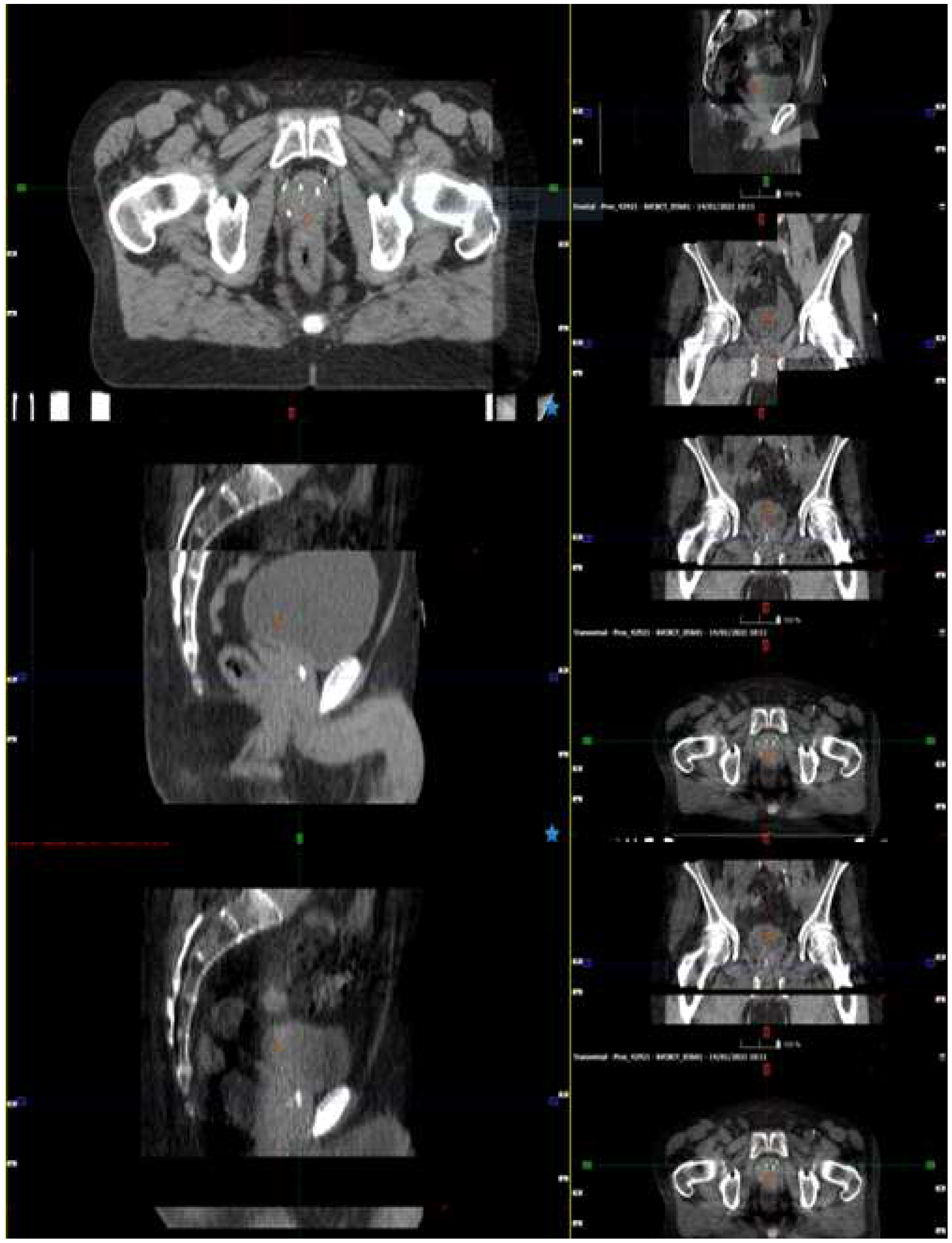 UroLift implants as surrogate fiducial markers for cone-beam CT-based ...