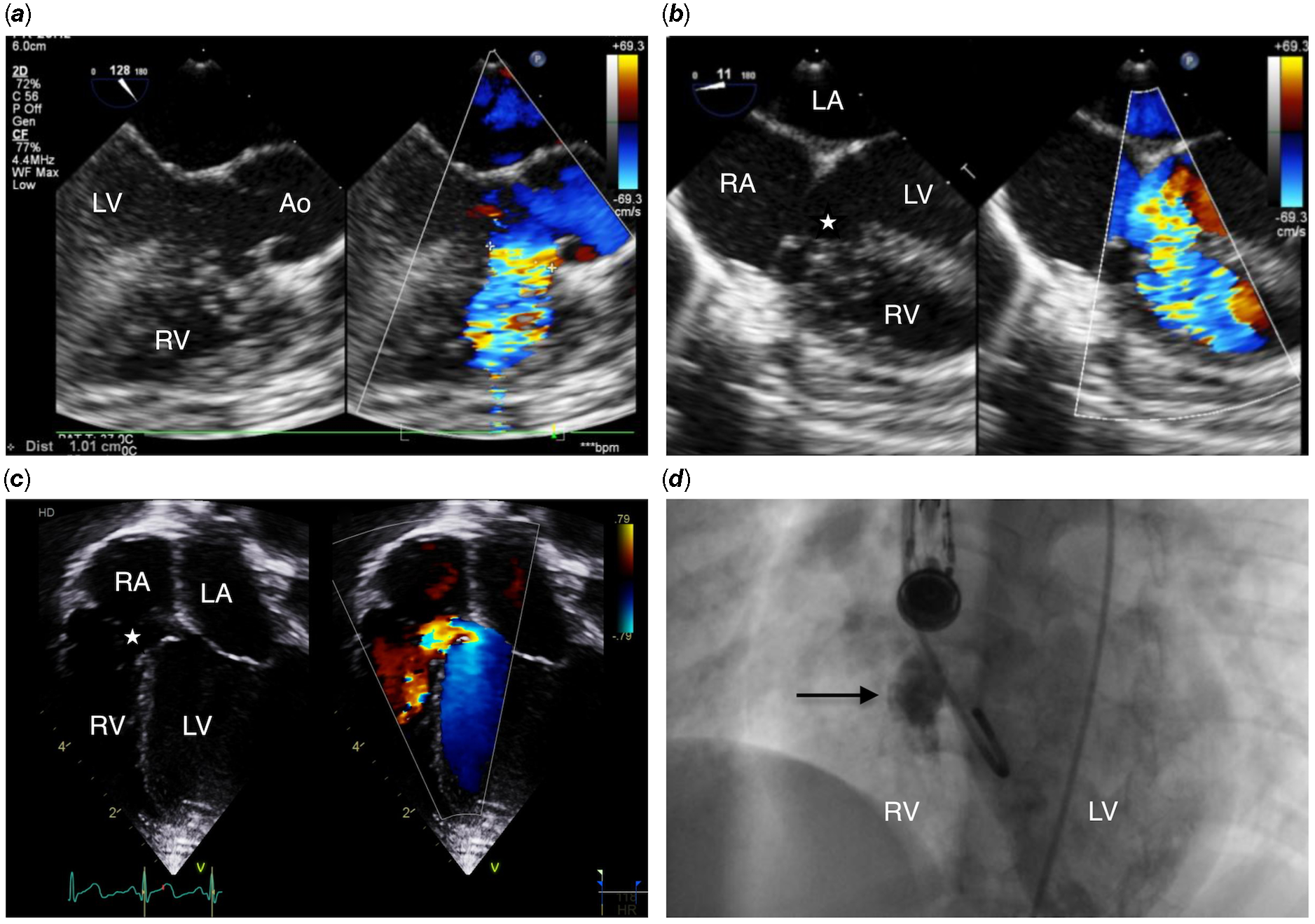 Transcatheter closure of large perimembranous ventricular septal ...