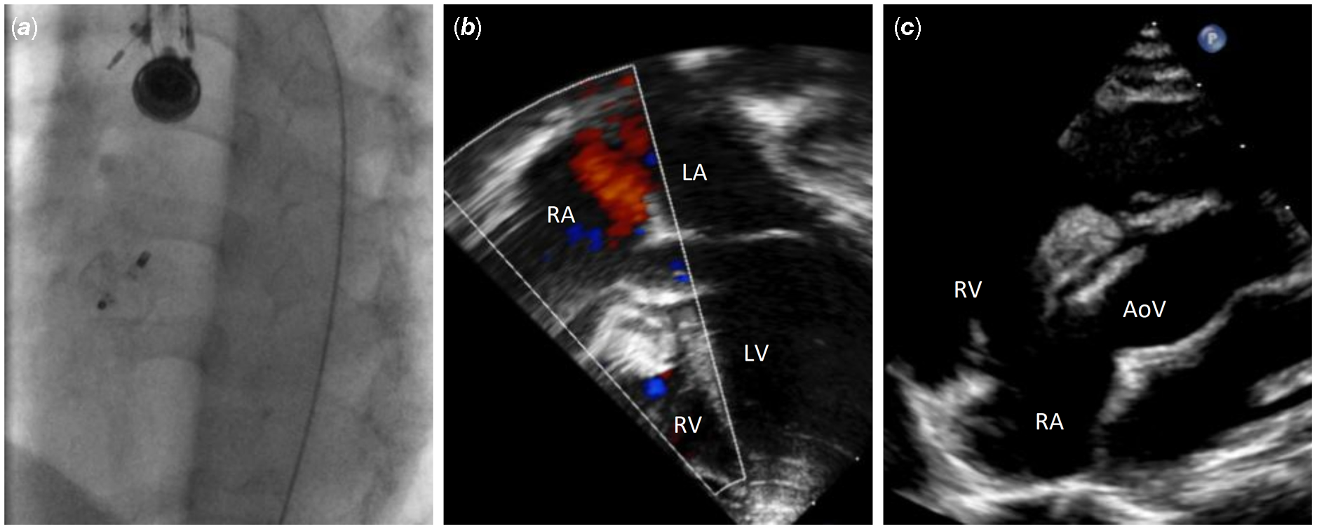 Transcatheter closure of large perimembranous ventricular septal ...