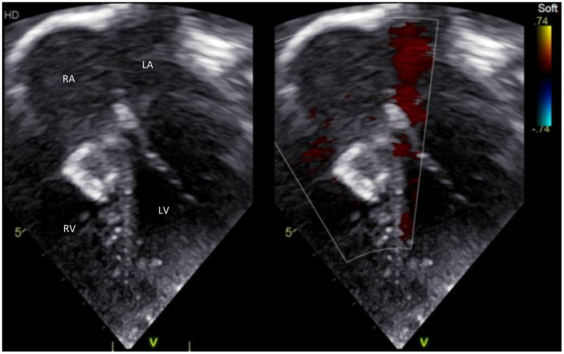 Transcatheter closure of large perimembranous ventricular septal ...