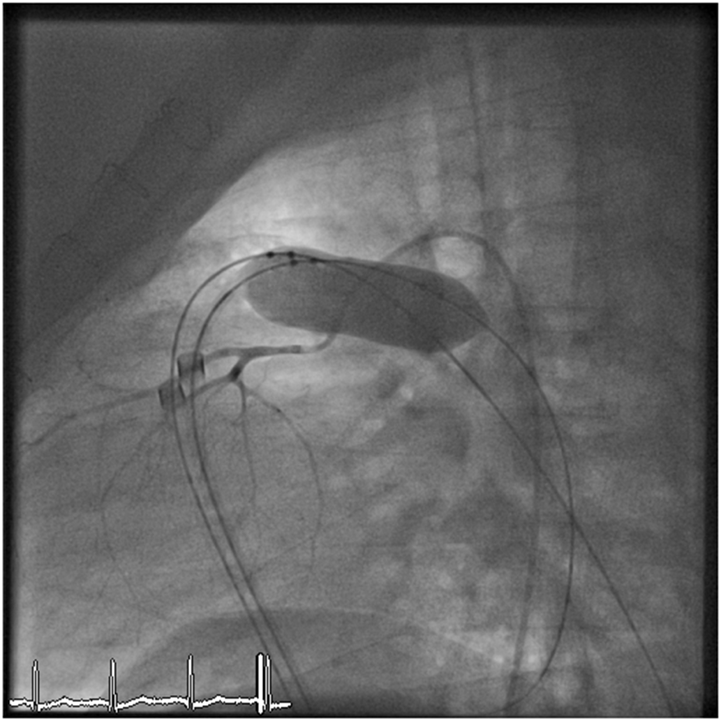 Coronary artery compression by pulmonary artery stenting after arterial ...
