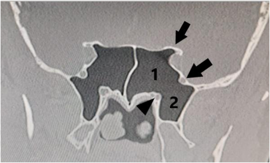Frontal sinus pneumatisation: an isolated finding or a sign of ...