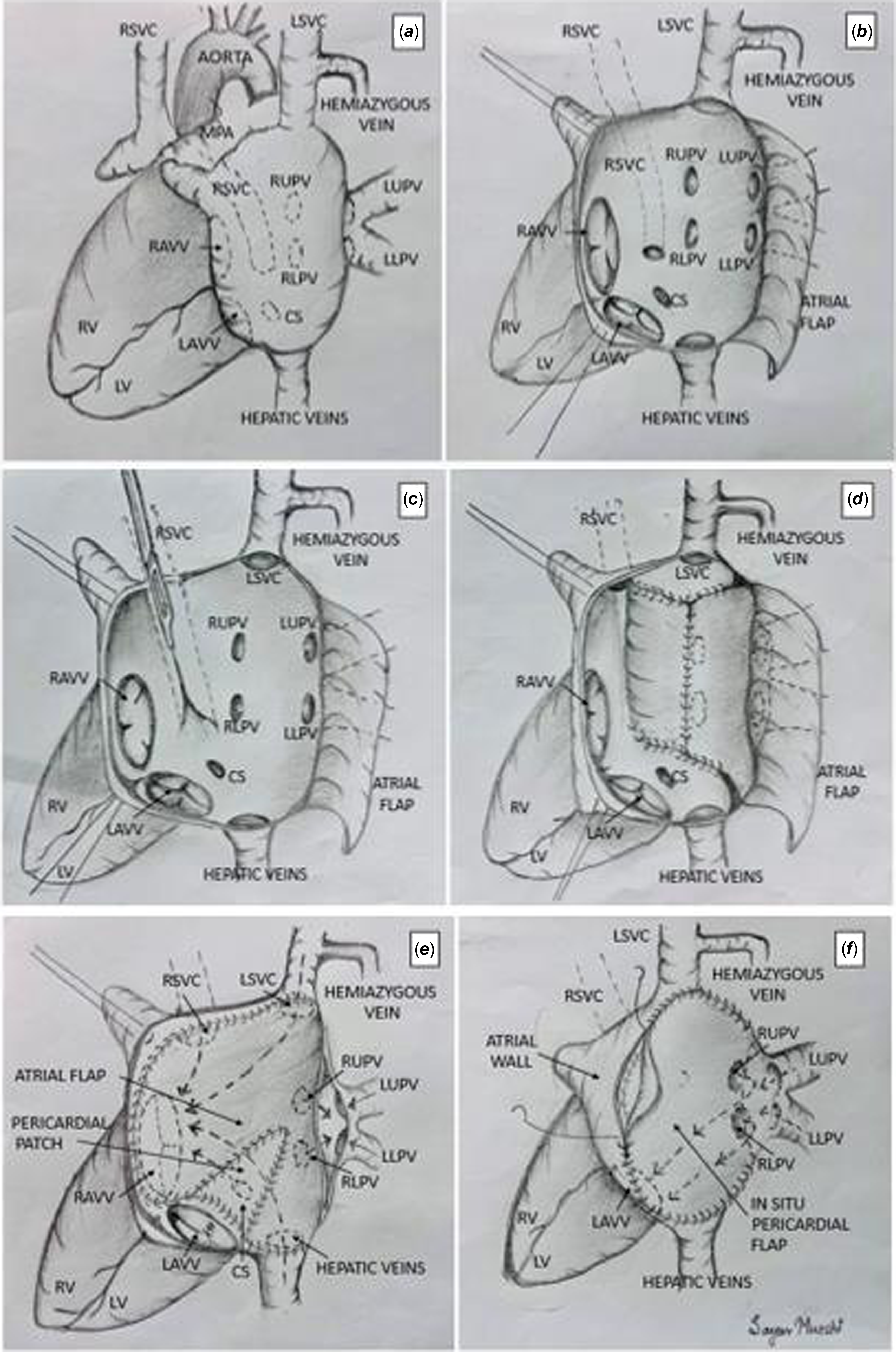 Modified Senning procedure in a patient with dextrocardia with left ...