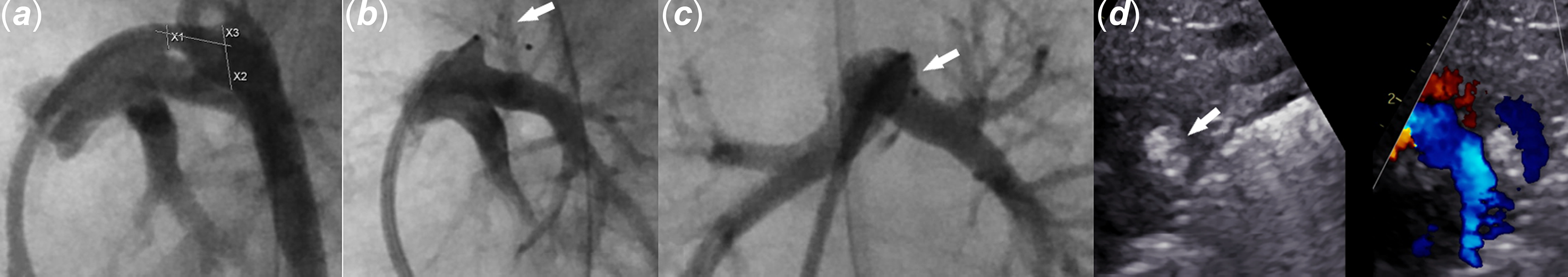 Patent ductus arteriosus closure in small infants weighing less than ...