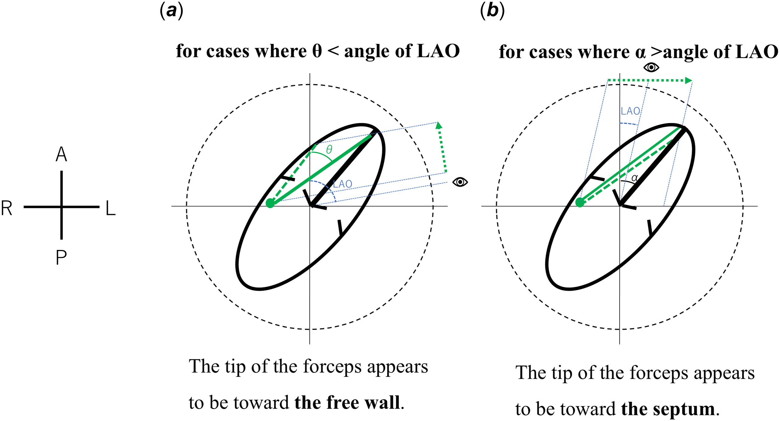 Fluoroscopic angles should be individualised when performing myocardial ...