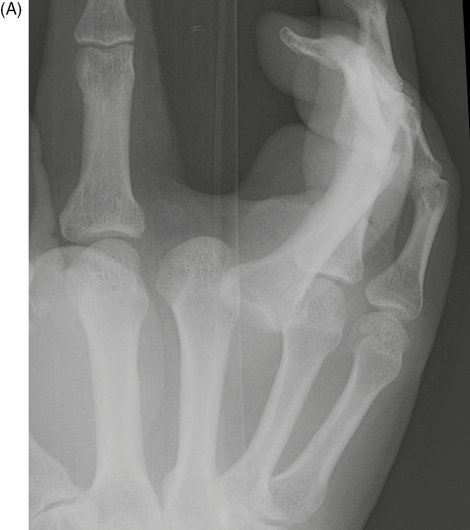 Metacarpophalangeal Joint Fracture