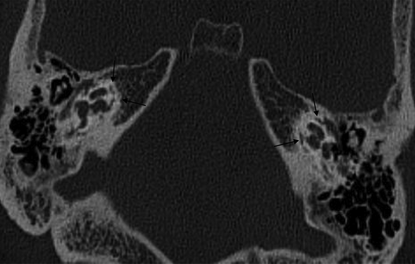 Computed tomography features of luetic osteitis (otosyphilis) of the ...