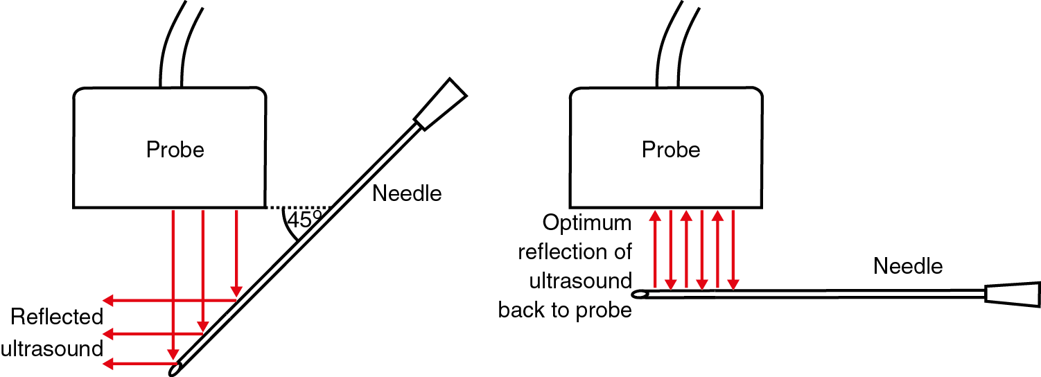 Can’t seem to get US guided PIV : r/Residency