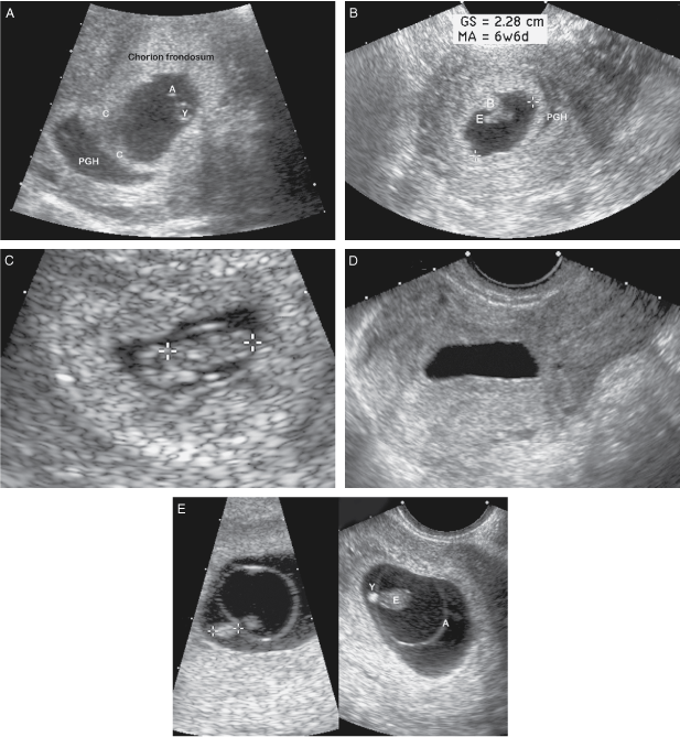 chorionic bump vanishing twin