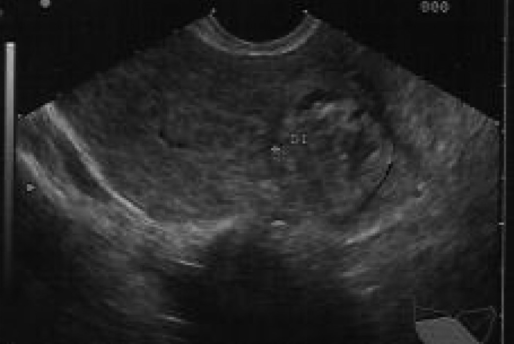 Interstitial Ectopic Pregnancy By Transvaginal Ultrasound The Arrow