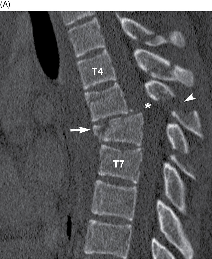 T5 Fracture