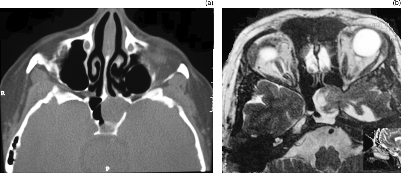 Management of spontaneous cerebrospinal fluid leaks of the sphenoid ...