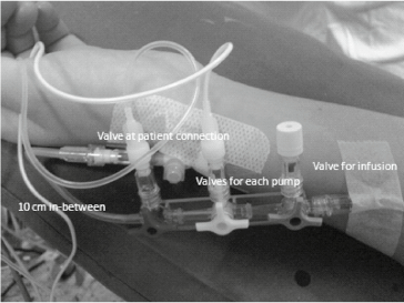 Set up mac procedure pumps for propofol in or - castsos