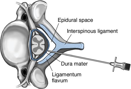 Interspinous Ligament Injection