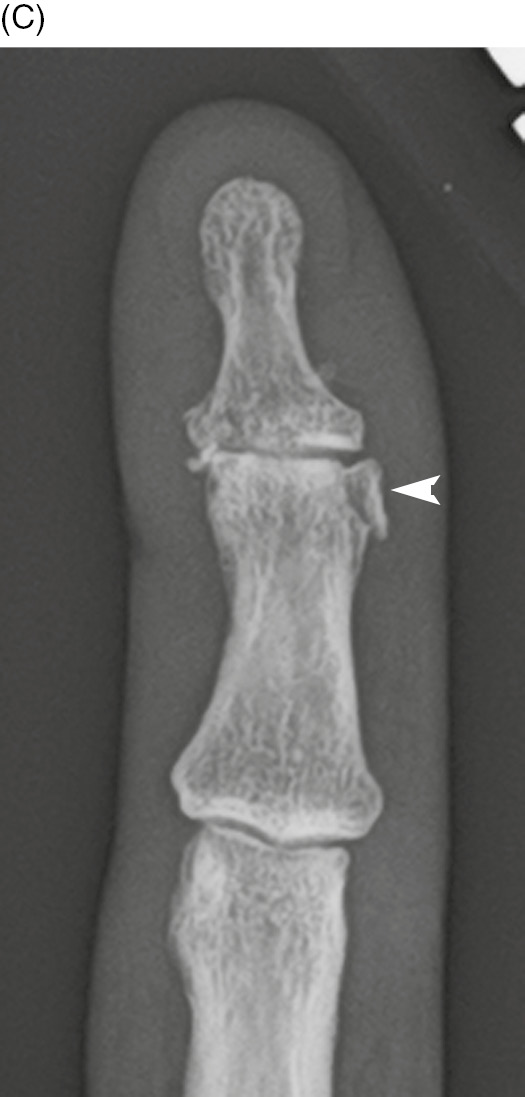 Distal Phalanx Tuft Fracture