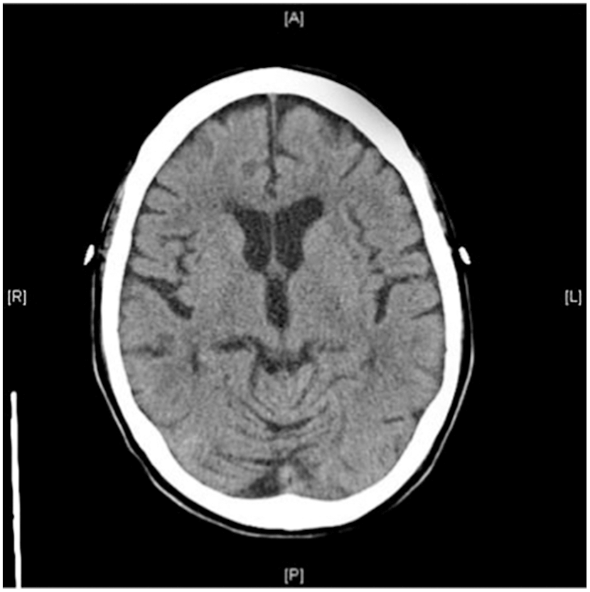 Ct Of Scleral Plaques