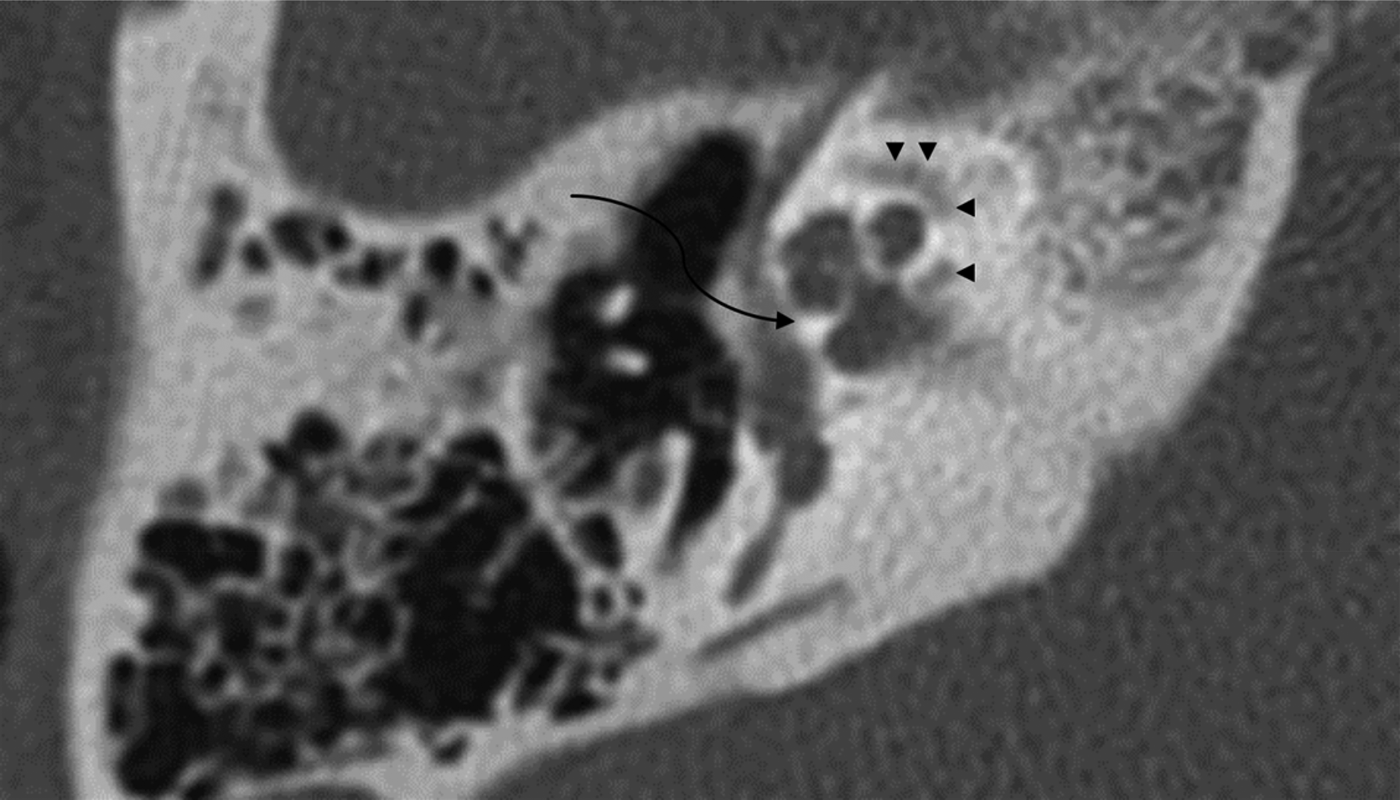 Computed tomography features of luetic osteitis (otosyphilis) of the ...