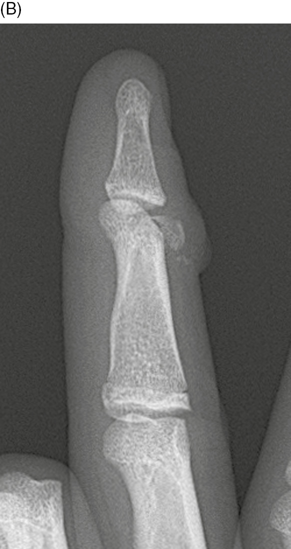 Distal Phalanx Tuft Fracture