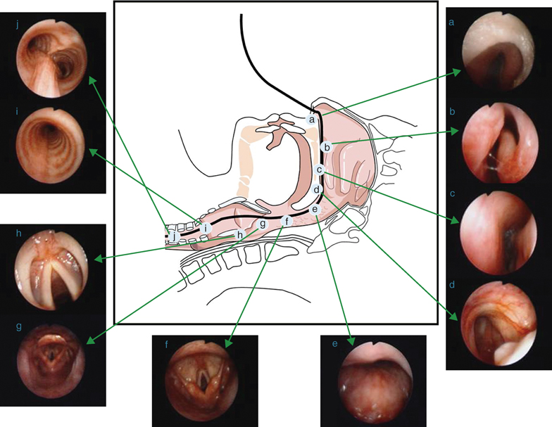 Tracheal Intubation And Endoscopic Anatomy Anatomy Tracheal