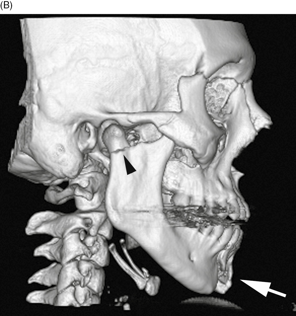 Maxilla Fracture
