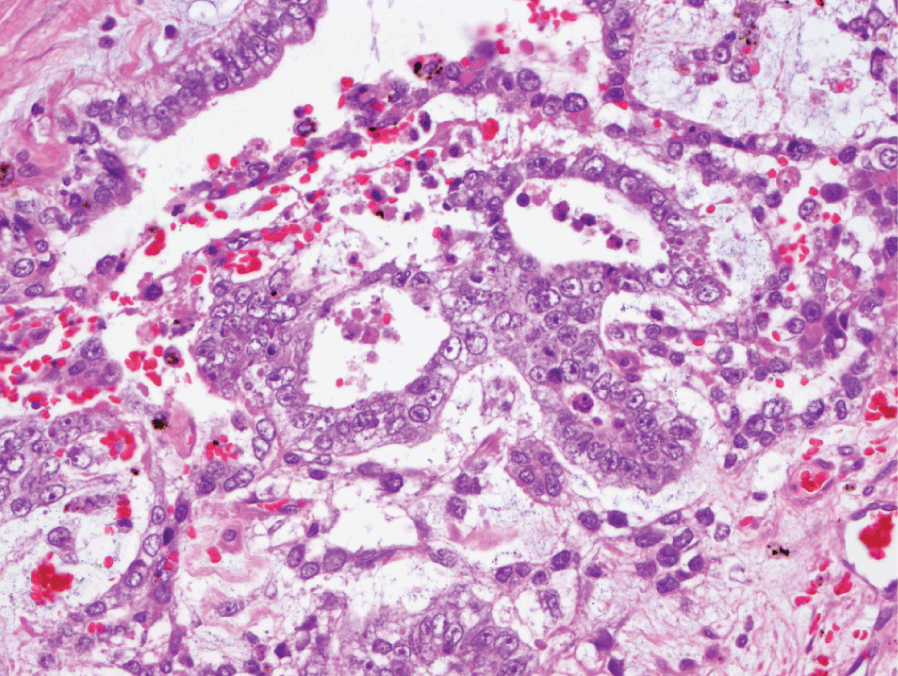 Yolk Sac Tumor Schiller Duval Bodies