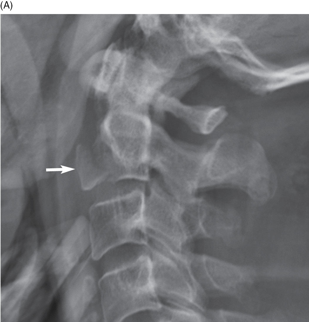 Posterior Neural Arch Fracture