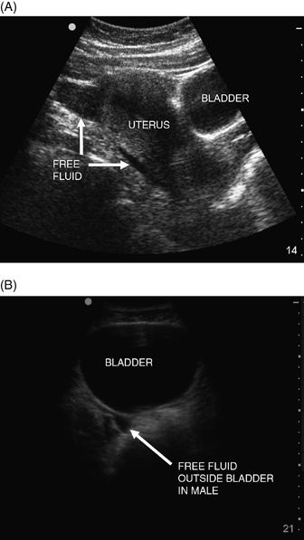 Vesicouterine Pouch Ultrasound