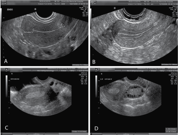 Ultrasound Early Proliferative Phase The Endometrium On Ultrasound