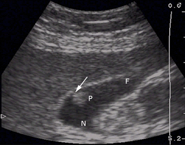 Gallbladder Polyps Ultrasound